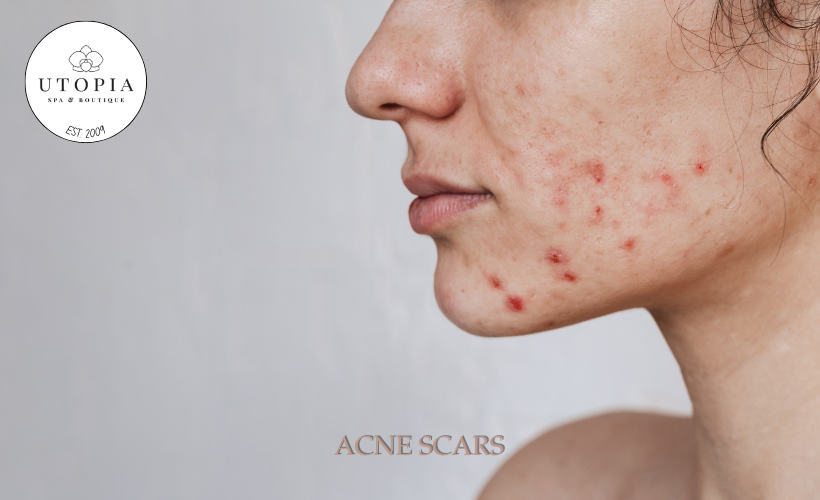 Acne Scars: Getting the Right Treatment in Milton Ont. - Utopia Spa ...